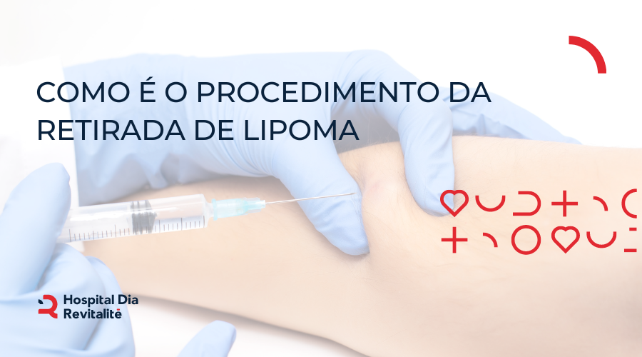 Como é o procedimento da retirada de Lipoma